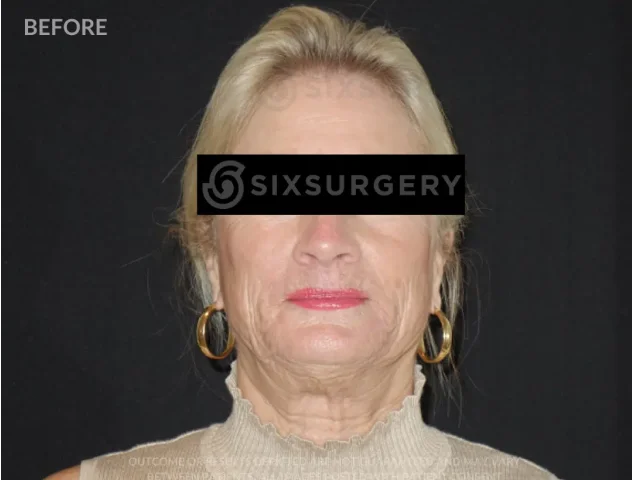 Top Facelift Plastic Surgeon | Toronto Cosmetic Surgery Institute
