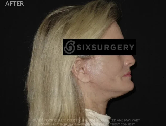 Top Facelift Plastic Surgeon | Toronto Cosmetic Surgery Institute