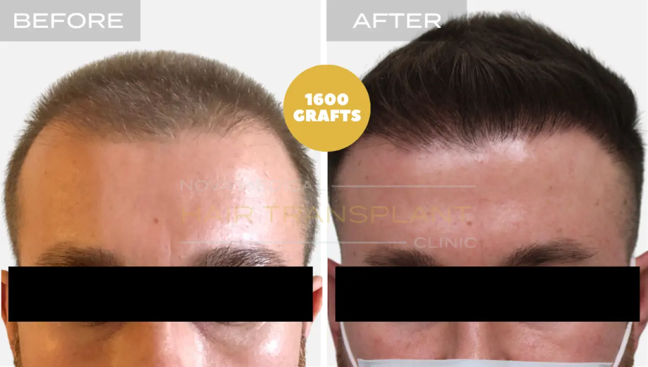 Hair Transplant - Toronto Cosmetic Surgery Institute