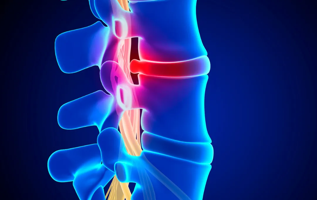 About Disc Bulge or Herniated Disc | Anchor Health Mississauga