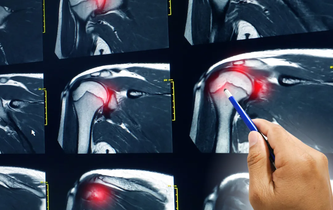 About Rotator Cuff Dysfunction | Anchor Health Mississauga