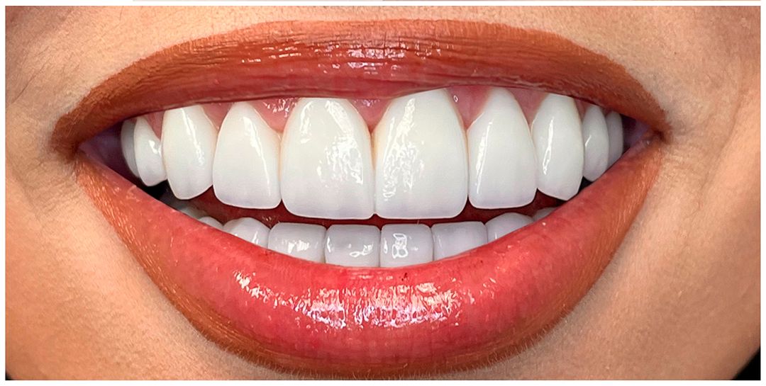 Orange County Cosmetic Dentist and Veneer Specialist : Transformative ...