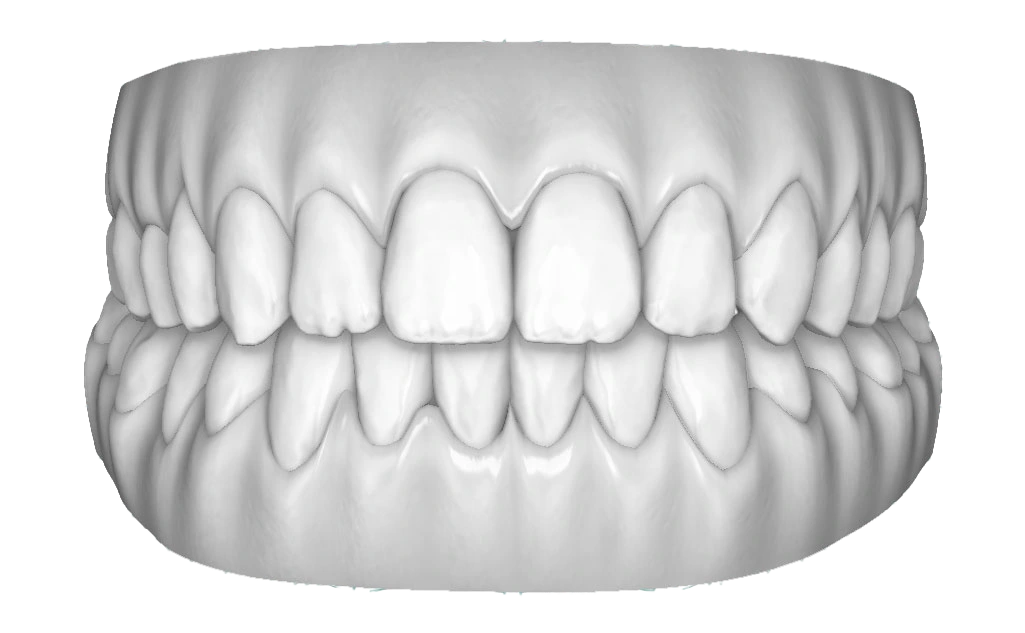 Fehlstellungen & Lösungen – Engstand | Kieferorthopädie Zürichberg