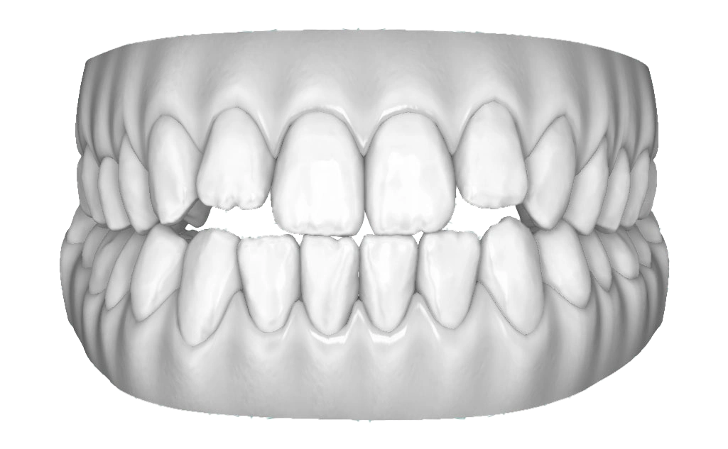 Fehlstellungen & Lösungen – Engstand | Kieferorthopädie Zürichberg