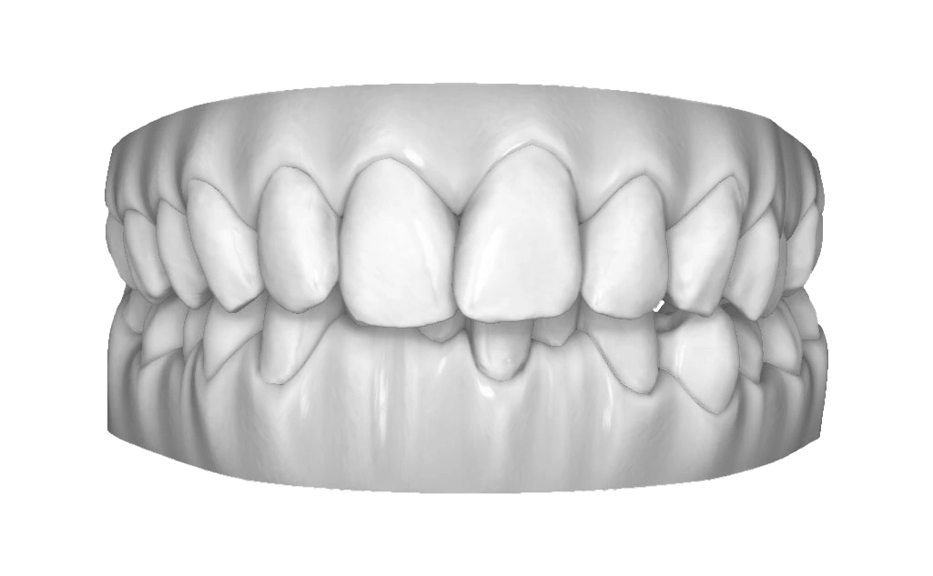 Fehlstellungen & Lösungen – Engstand | Kieferorthopädie Zürichberg