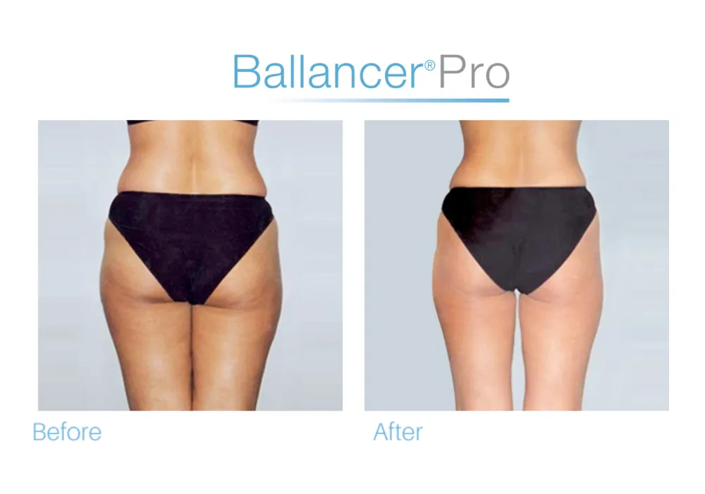 Ballancer® Pro Platinum