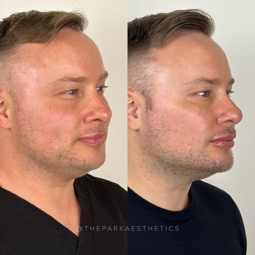 Before & After Gallery | See the Transformations at Park Aesthetics