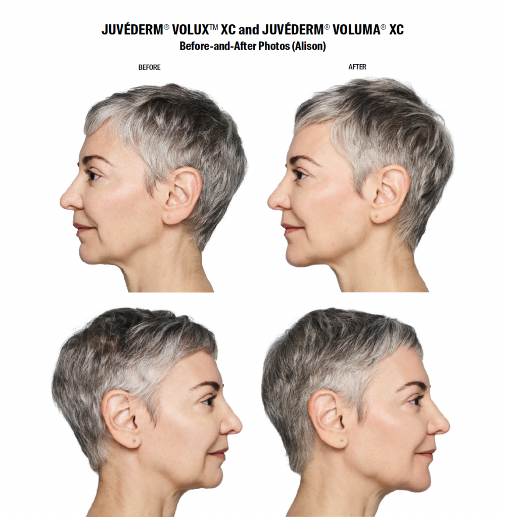 Before and After Photos of Juvederm Volux Female Patient