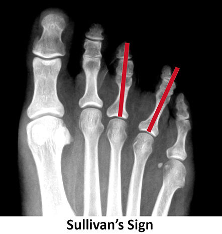Morton's Neuroma | Gulf South Foot & Ankle