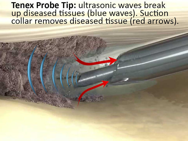 Achilles Tendonitis and Plantar Fasciitis | Gulf South Foot & Ankle