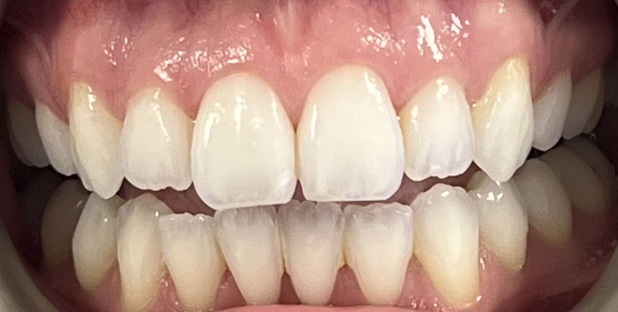 Smile Gallery | Henley Reach Dental, Henley-on-Thames, Oxfordshire