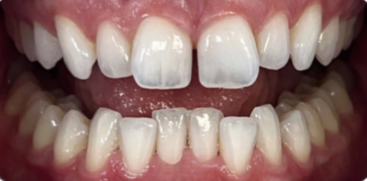 Smile Gallery | Henley Reach Dental, Henley-on-Thames, Oxfordshire
