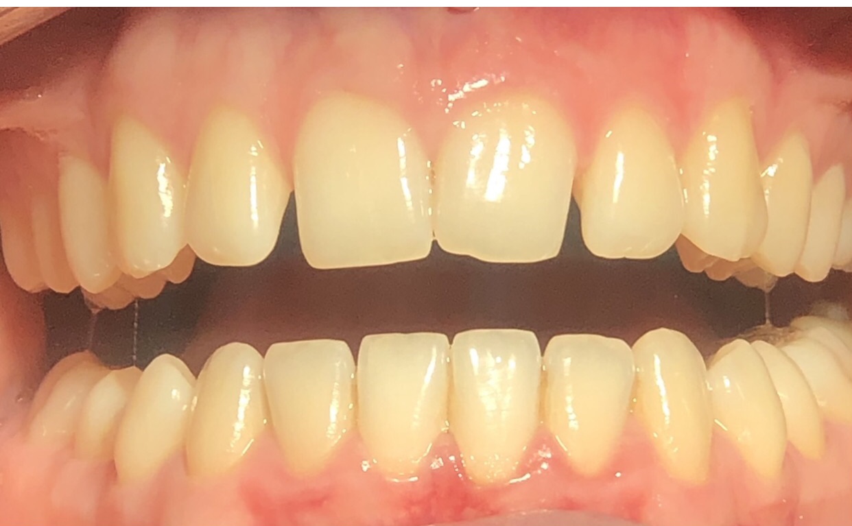 Smile Gallery | Henley Reach Dental, Henley-on-Thames, Oxfordshire