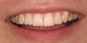 Highest quality composite bonding in Liverpool | Improve your smile ...