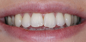 Fastbraces teeth straightening in Liverpool | See us at Dr Rez Dental ...