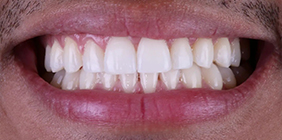 Invisalign clear aligners in Liverpool | See us at Dr Rez Dental for ...