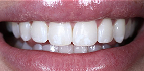 Invisalign clear aligners in Liverpool | See us at Dr Rez Dental for ...