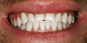 Highest quality composite bonding in Liverpool | Improve your smile ...