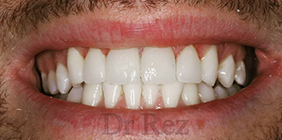 Highest quality composite bonding in Liverpool | Improve your smile ...