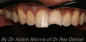 Highest quality composite bonding in Liverpool | Improve your smile ...