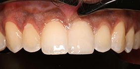 Highest quality composite bonding in Liverpool | Improve your smile ...