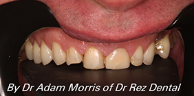 Professional dental veneers in Liverpool | Fix a broken tooth, shape ...