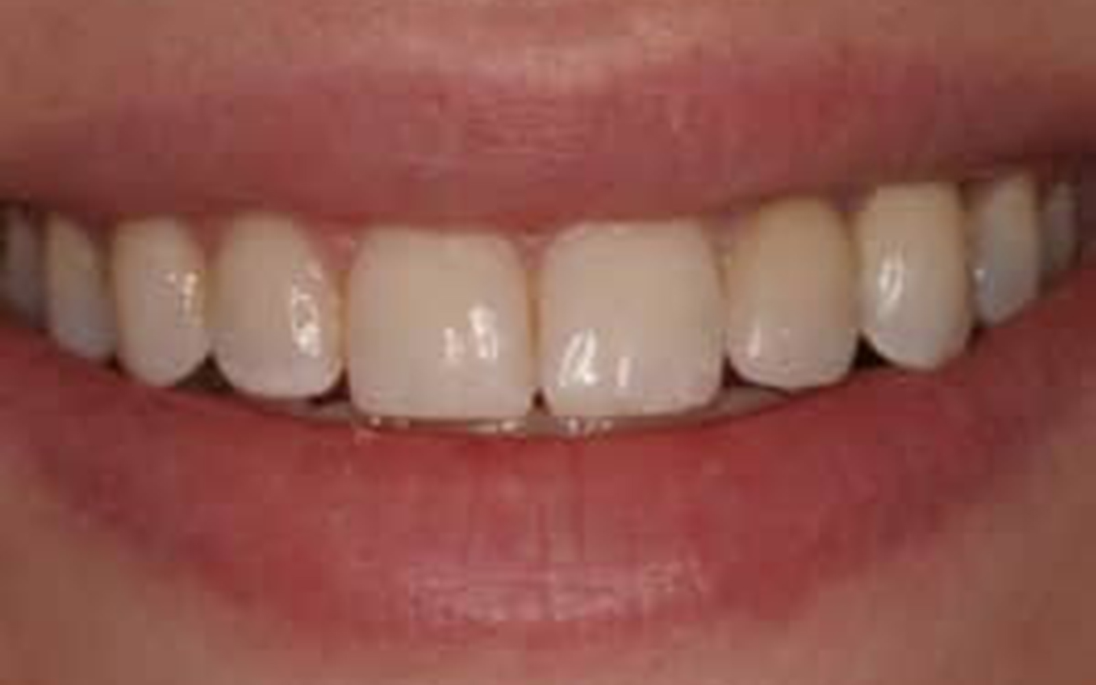 Dentist in Renton | Benson Hill Smiles