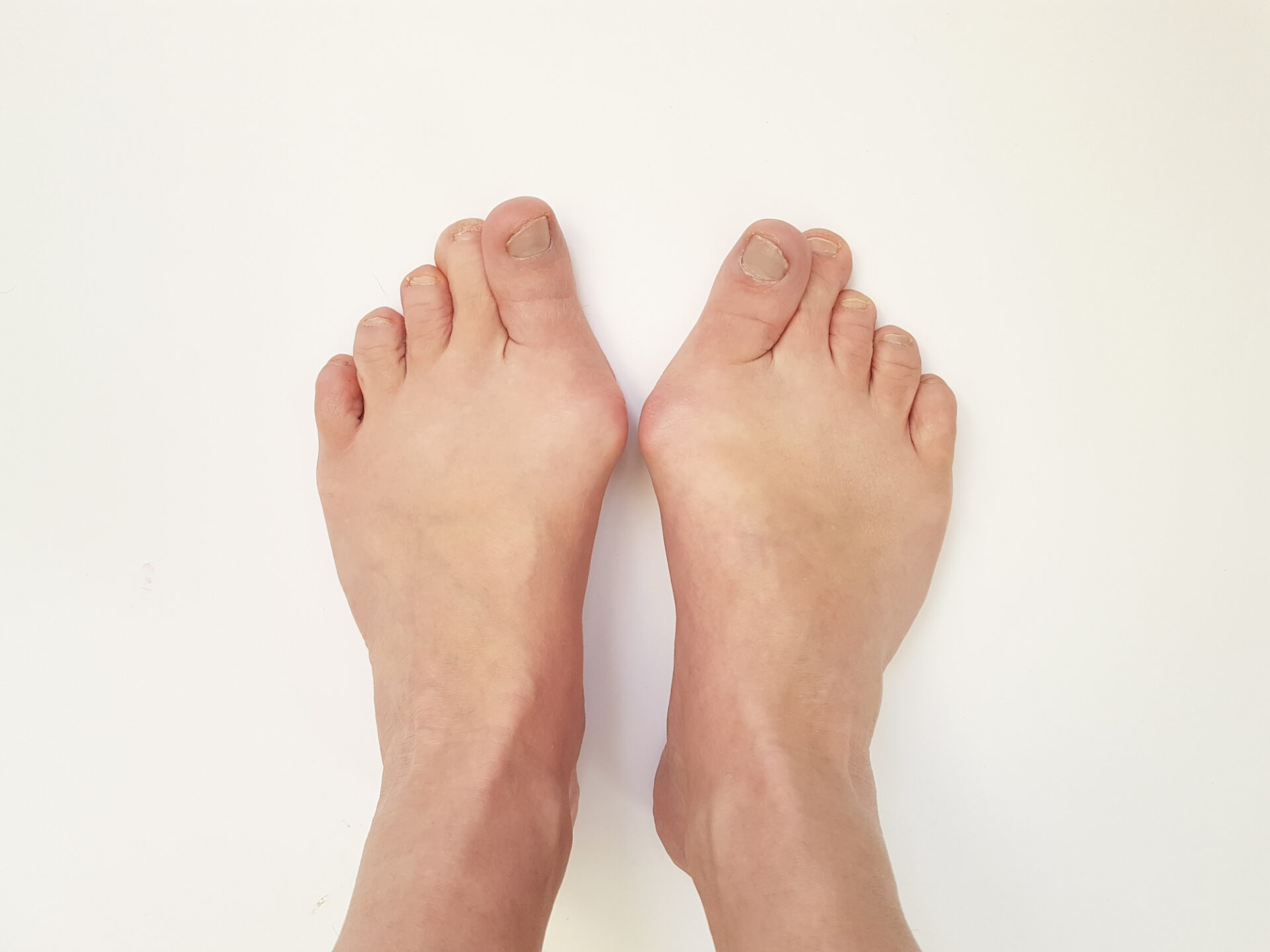 Bunion Basics: Understanding and Managing Foot Bunions - Feet First ...