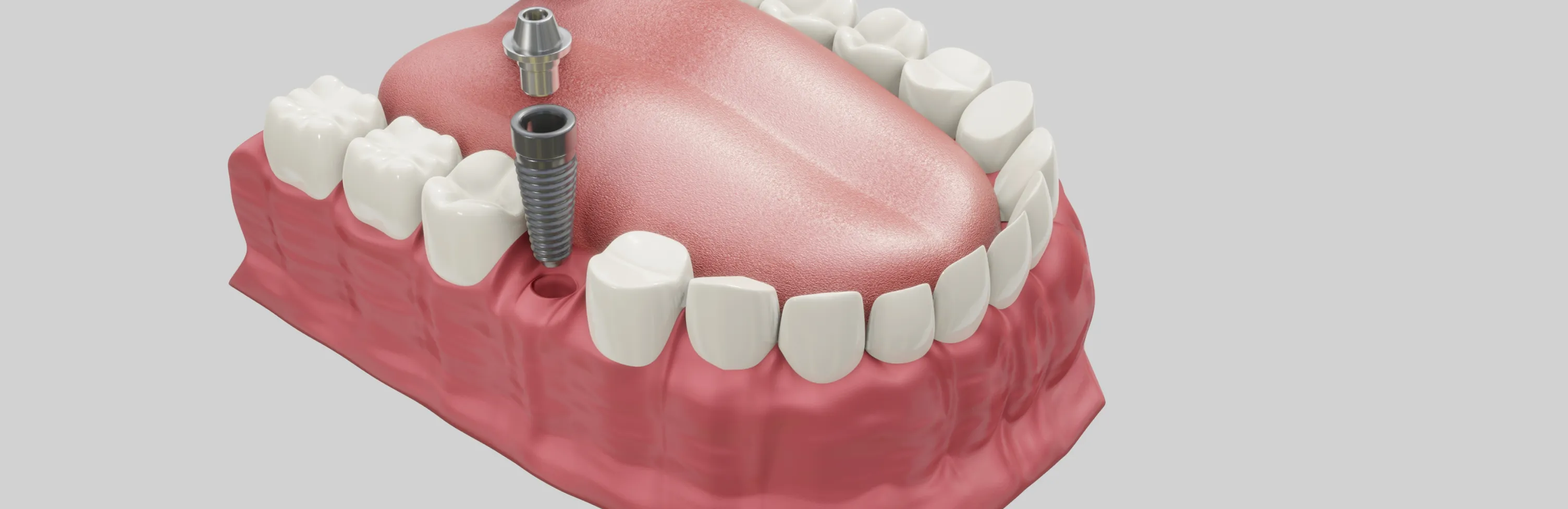 Post-Op Care for Dental Implants