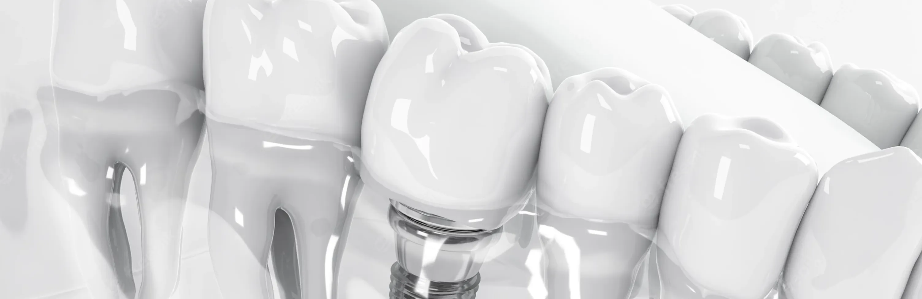 Multiple Teeth Replacement Options