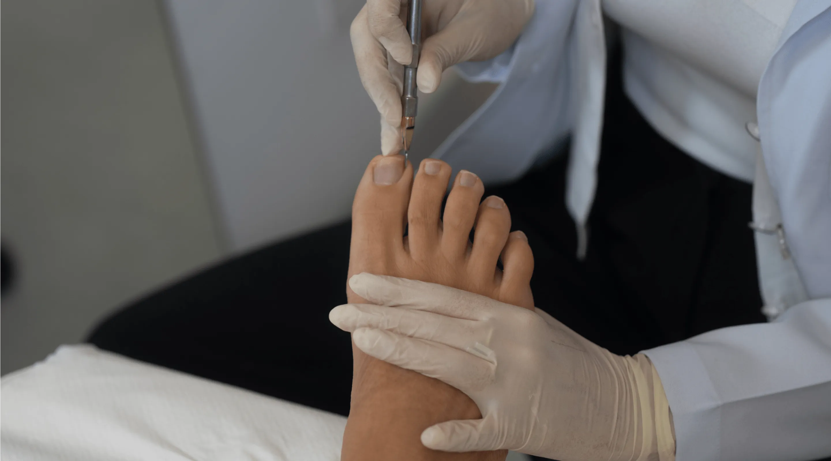 Ingrown Toe Nails: Causes, Treatment, and Preventio