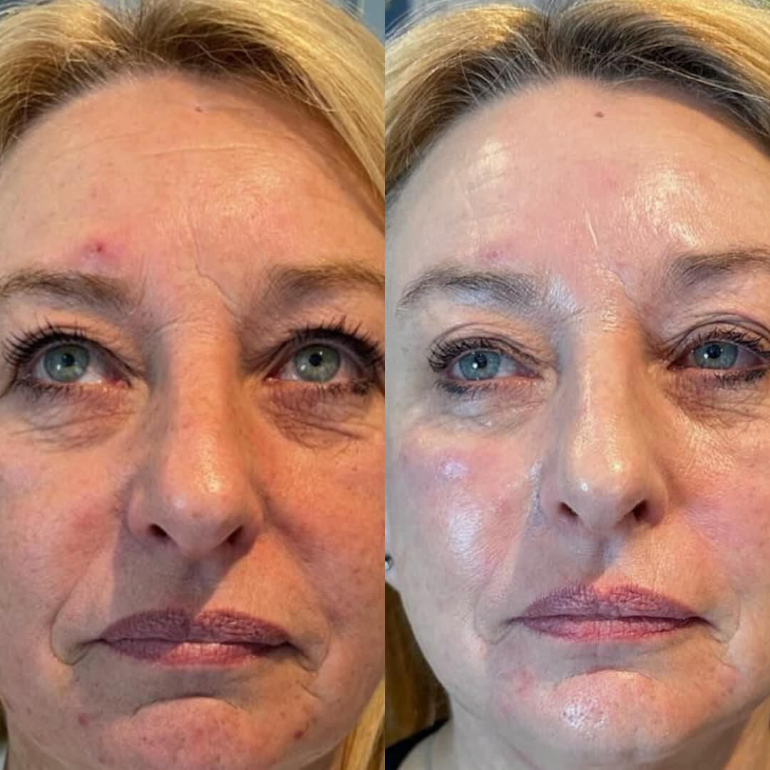 Skin Boosters - SuneKOS® Performa