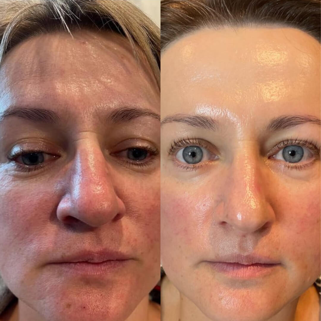 Skin Boosters - SuneKOS® Performa