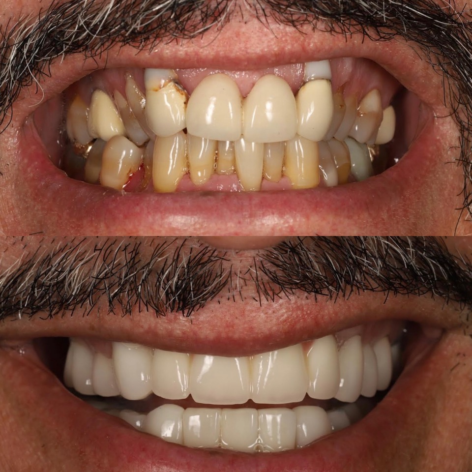 Dental Treatment Gallery | 905 Dental, Brampton, Ontario