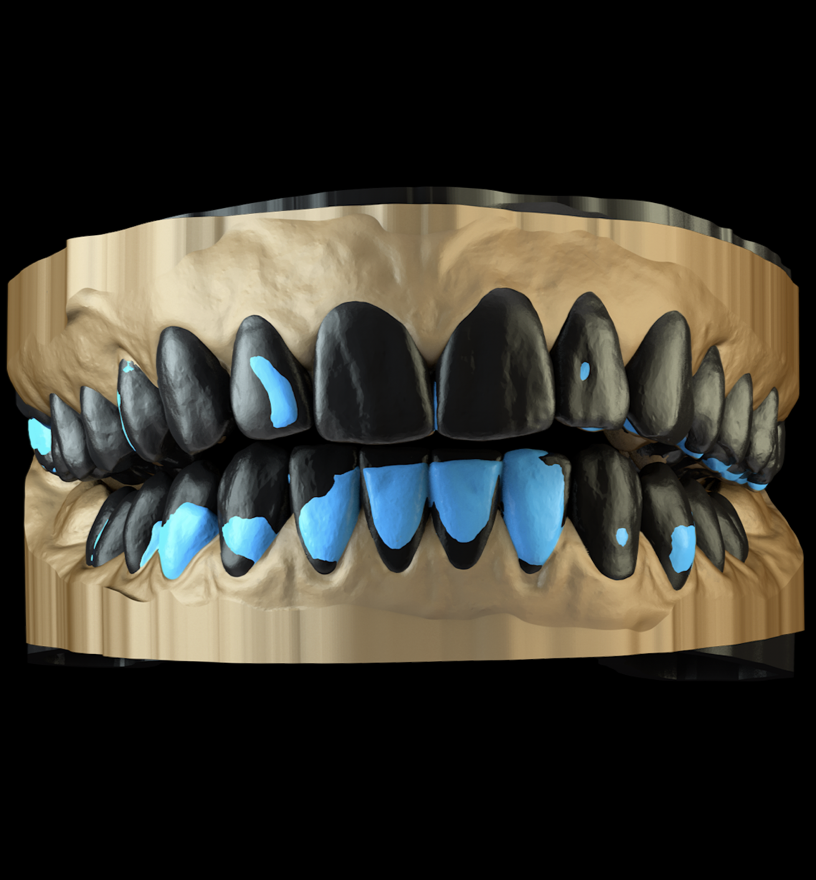 Metalab - Outsource Dental Designs