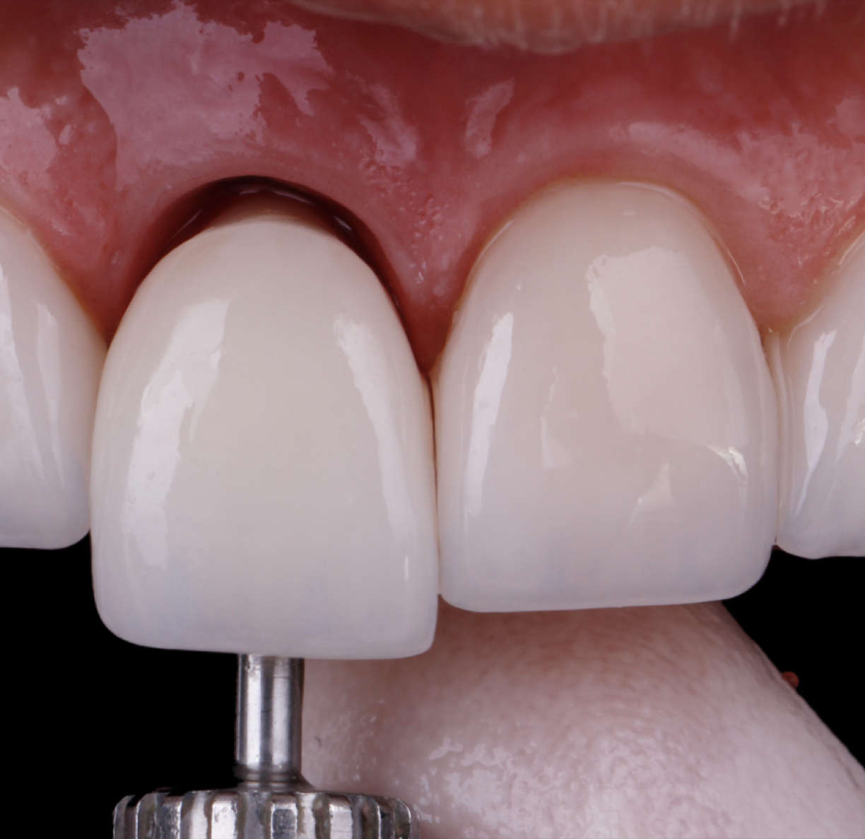 Metalab - Outsource Dental Designs