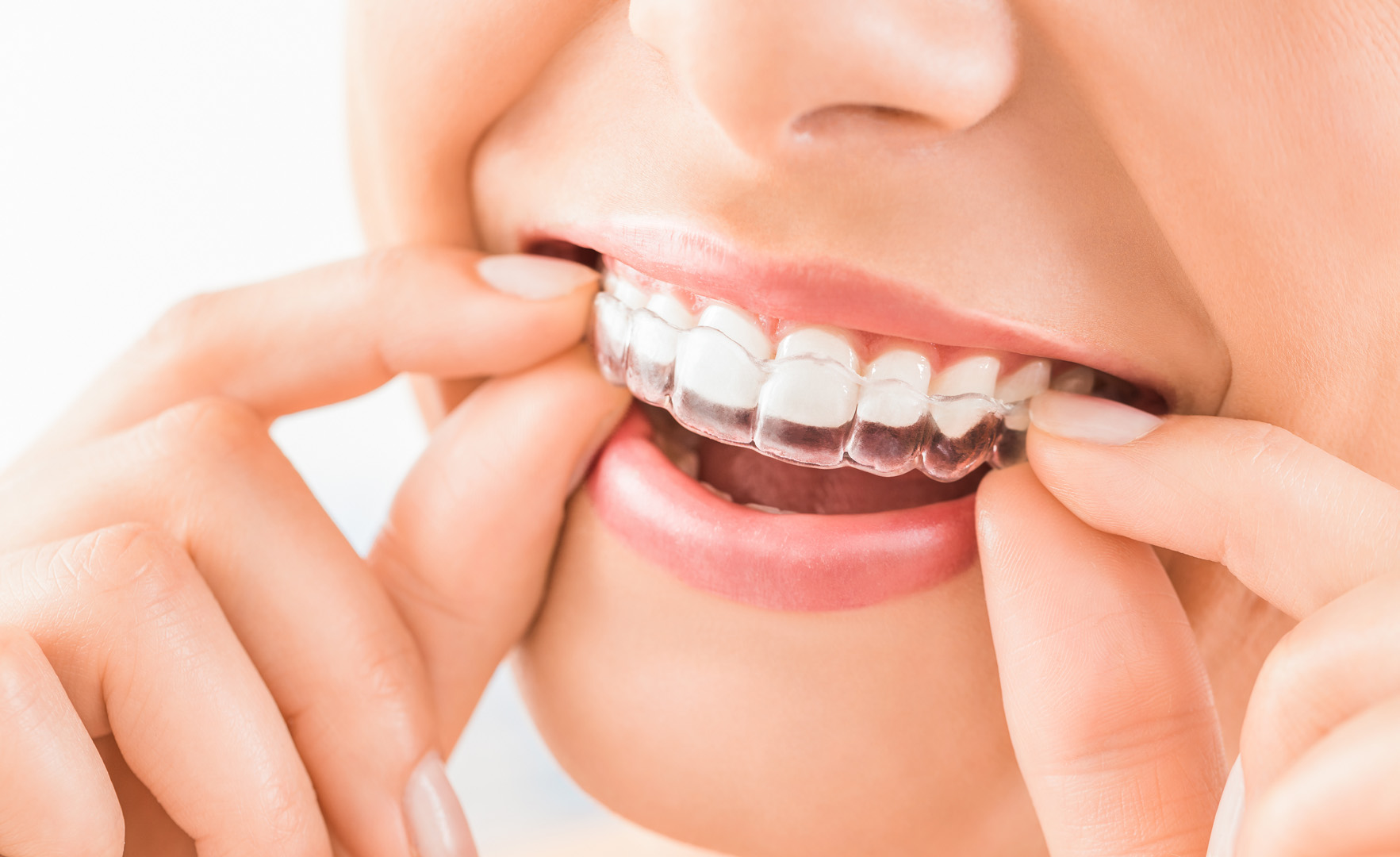 Invisalign Clear Teeth Aligners in Hot Springs, AR | Smile Hot Springs