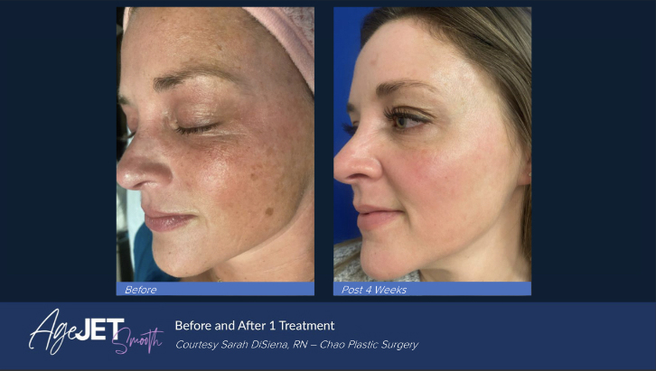 AGEJET Treatment | Hilton Head , South Carolina