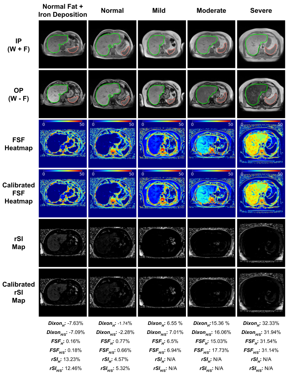 Deep Learning Based 3d Whole Liver And Spleen Segmentation For Quantitatively Reproducible Liver