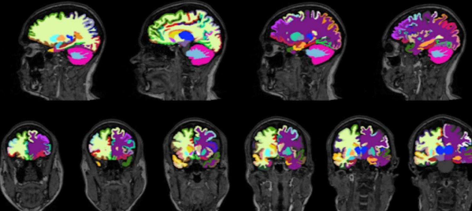 Deep Learning Derived Visceral Abdominal Fat Predicts Brain Atrophy at ...