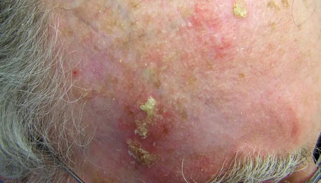 Services | Medical Dermatology | Actinic Keratosis