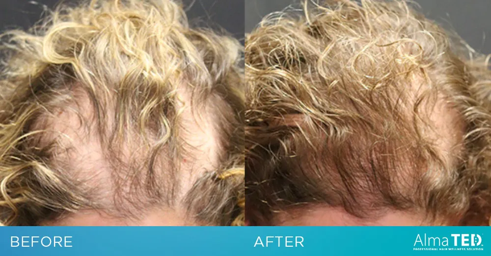 Alma TED Hair Restoration | Silver Tree Wellness Center | Phoenix, AZ