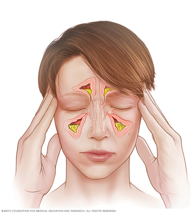 Sinus Conditions & Cranial Facial Release (CFR) - Limitless ...