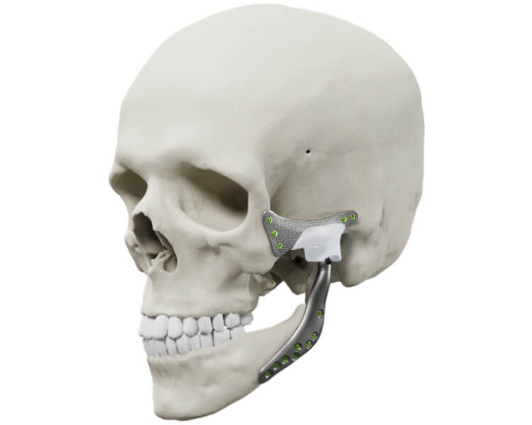 TMJ Concepts | Stryker