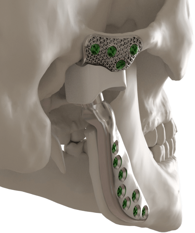 TMJ Concepts | Stryker