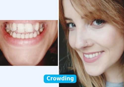 Straight My Teeth - Invisible Clear Aligners to Straighten Teeth at Home