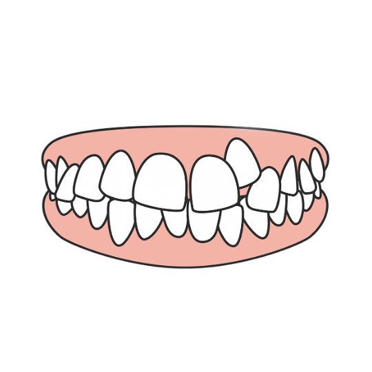 StraightMyTeeth: Your Guide to Teeth Straightening