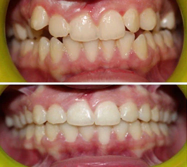 Caspersmile Clear Aligners Review