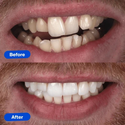 Smile Whites Clear Aligners Review