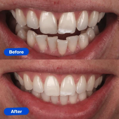 Smile Whites Clear Aligners Review
